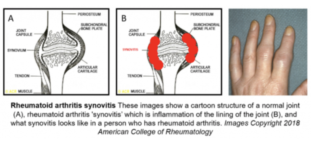 What Is Synovitis Rheumatoid Arthritis Coach
